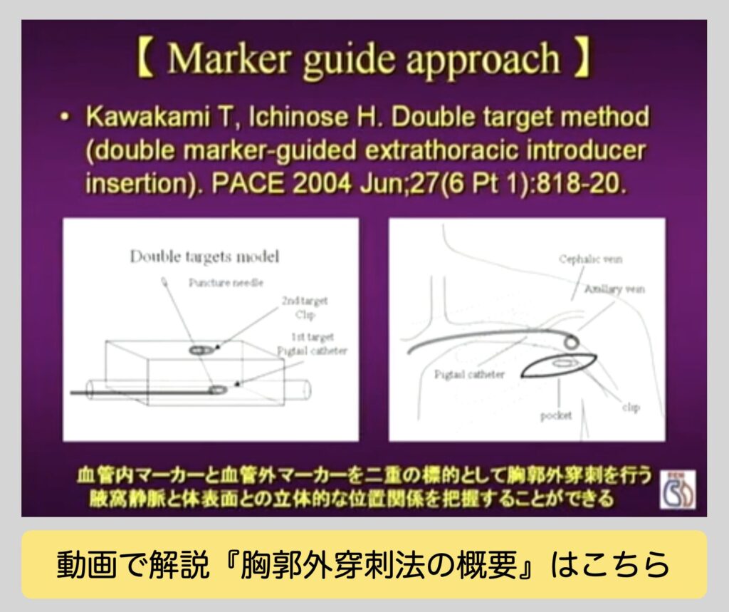 胸郭外穿刺の重要性とDouble Target法 - 包括的不整脈治療研究所